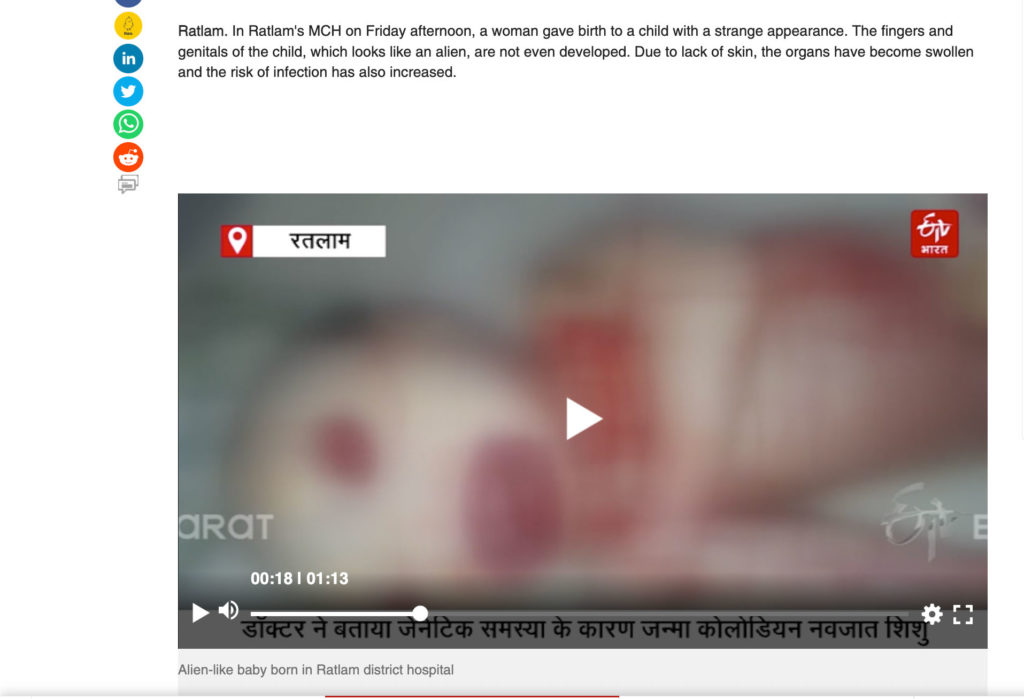 The baby in this video was born with a rare genetic disorder named ...