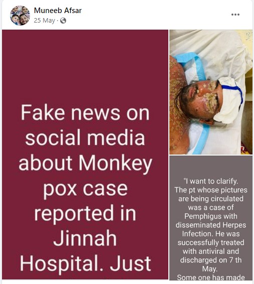 No case of lumpy skin disease in humans is reported in India since it’s ...