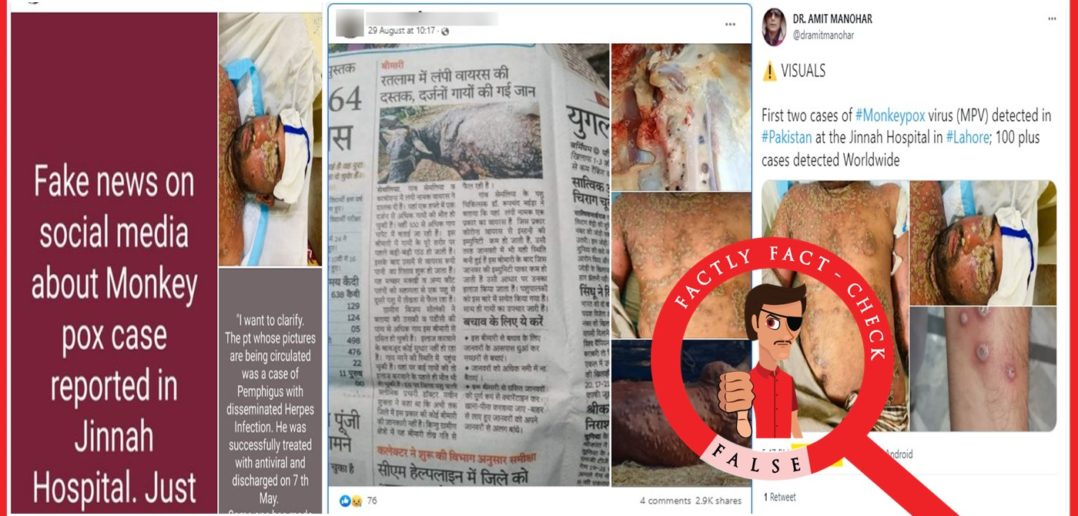 No case of lumpy skin disease in humans is reported in India since it’s ...