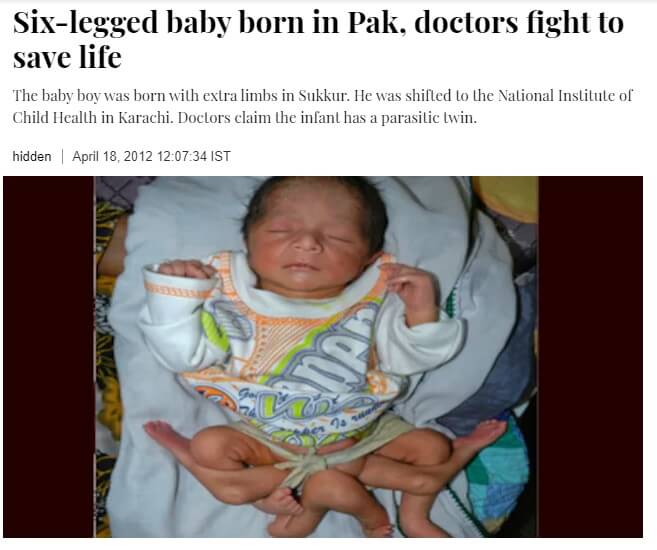 Humans With Extra Limbs