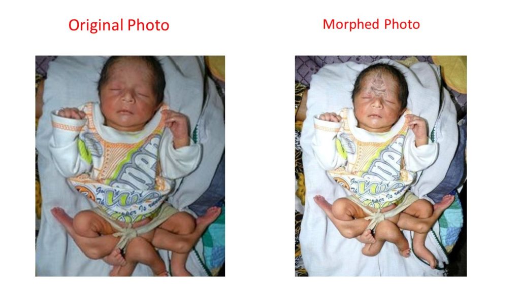 People With Extra Limbs