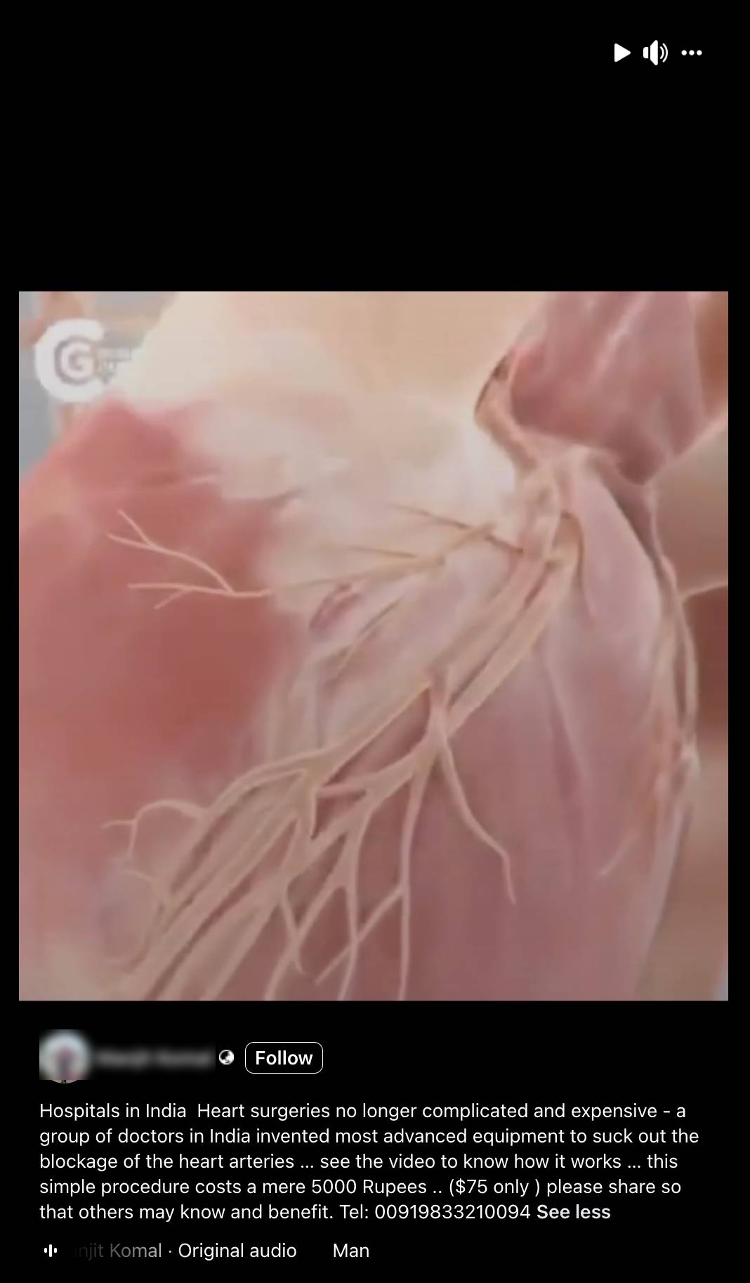 Megavac was developed by American radiologist Dr. Richard Fulton in 2013 and is not a recent ...