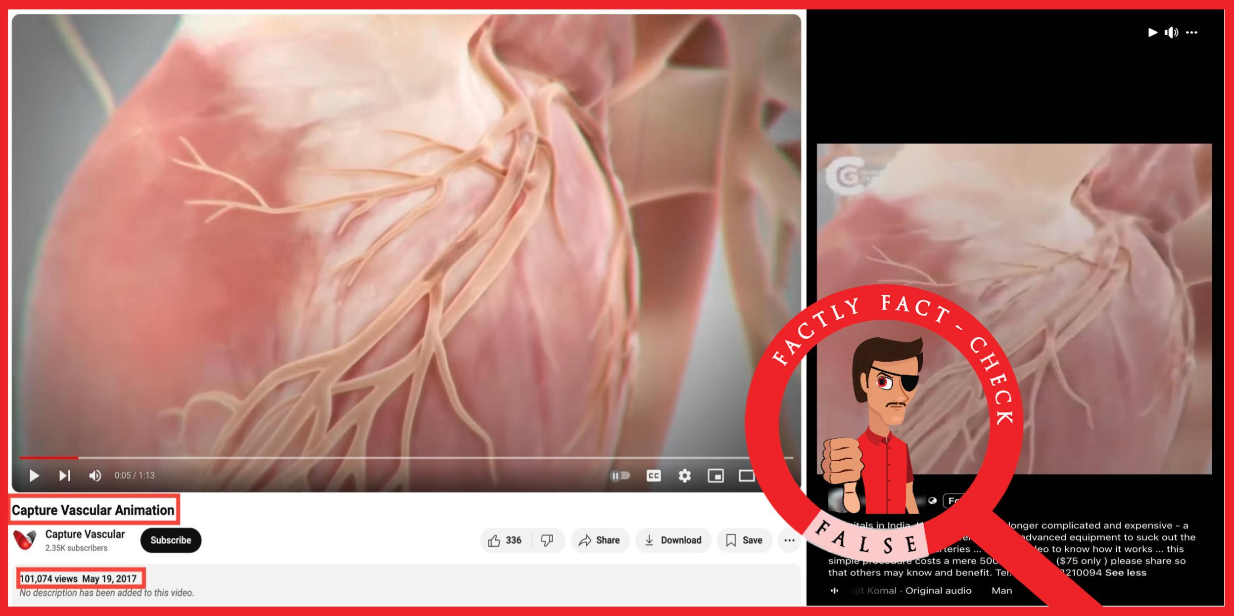 Megavac was developed by American radiologist Dr. Richard Fulton in 2013 and is not a recent ...